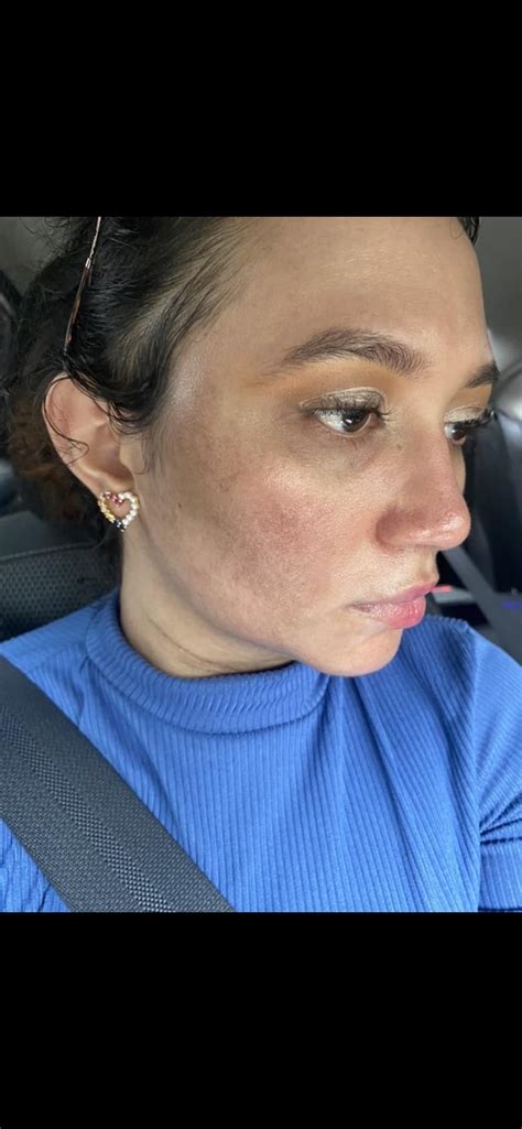 Routine Help For Hyperpigmentation After Microneedling Session R30plusskincare
