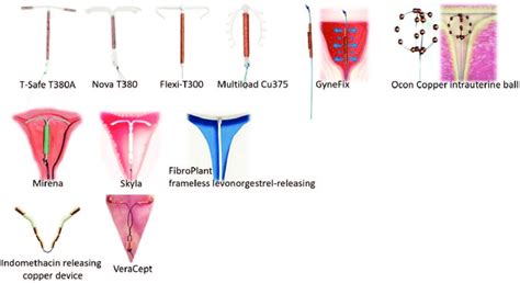 Diagram Uterus Diagram Iud Mydiagramonline