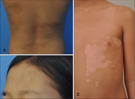 A Two Circumscribed Morphea On The Right And Left Sides Of The Back Download Scientific
