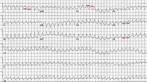 Ecg Case 183 Atrial Flutter With 11 Conduction Manual Of Medicine