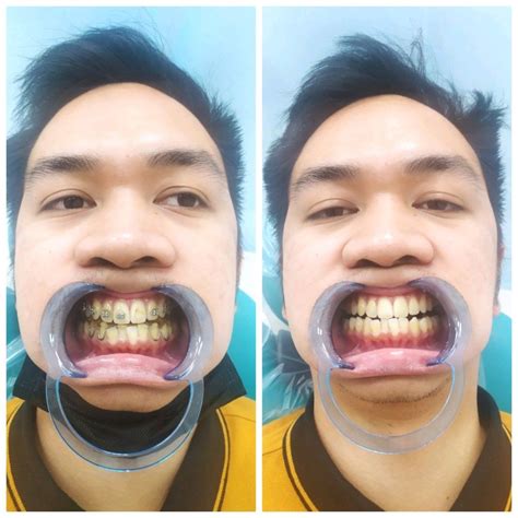 Dr Shebin Varghese On Linkedin Removal Of Orthodontic Brackets Followed By Scaling And