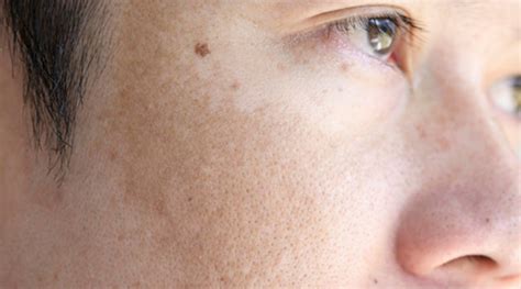 The Power Of Cholecalciferol How It Helps Combat Hyperpigmentation In Assembled Skincare