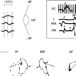 Above P Wave Morphology In I II And III Typical Of Third Degree Download Scientific