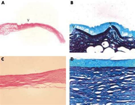 Histopathology Slides Of The Original Host Keratoconic Cornea Showing Download Scientific