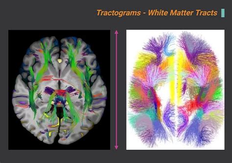 The Neurotypical Brain Versus The Autistic Brain