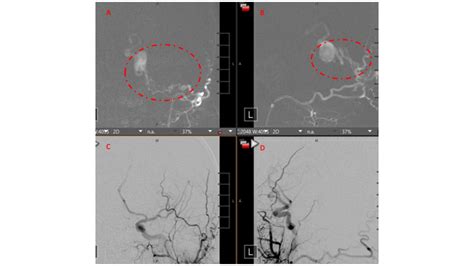 Brain Avm Ruptured Dural Avf Neurointerventional Medicine Pllc