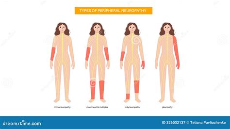 Peripheral Neuropathy Medical Poster Stock Vector Illustration Of Anatomy Diabetic 326032137