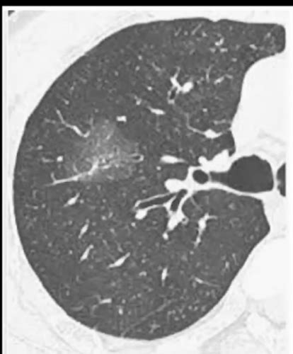 COPD Case Progression Lung Cancer ILab Pictures Flashcards Quizlet