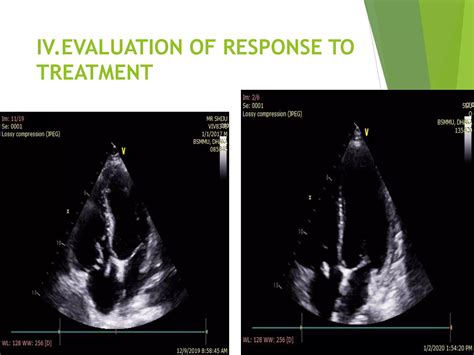 Infective Endocarditis Echo Dr Khaled Ppt