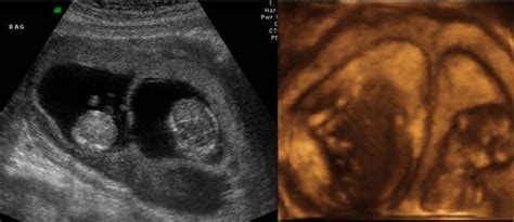 Pin On Twin Ultrasound Pin On Twin Ultrasound