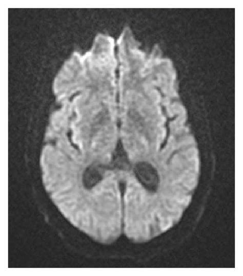 Single Small Nodular Enhancing Lesion With Discrete Central Hyposignal Download Scientific