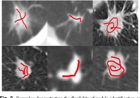 Figure 1 From Volumetric Lung Nodule Segmentation In Thoracic Ct Scan Using Freehand Sketch