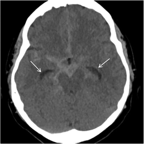Essentials Of Hydrocephalus Advances In Clinical Radiology