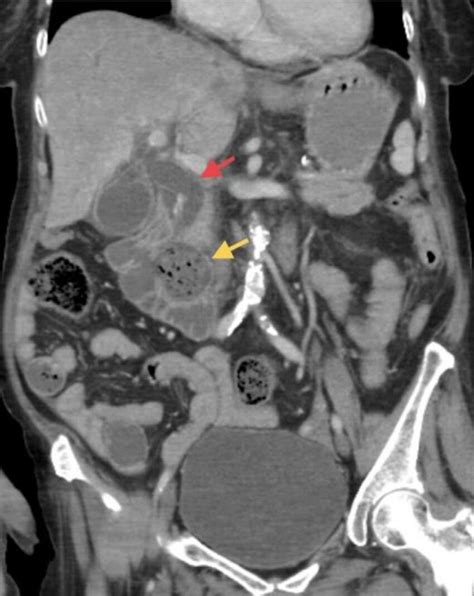 Duodenal Diverticular Bezoar Coronal Ct Image With Iv Contrast