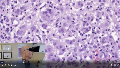 Epithelioid Neoplasm On The Face Juvenile Xanthogranuloma