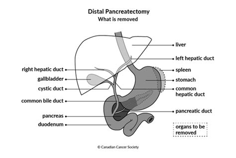 Surgery For Pancreatic Cancer Canadian Cancer Society