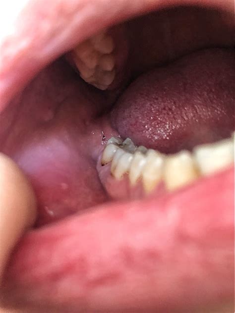 Прыщ во рту Вопрос стоматологу 03 Онлайн