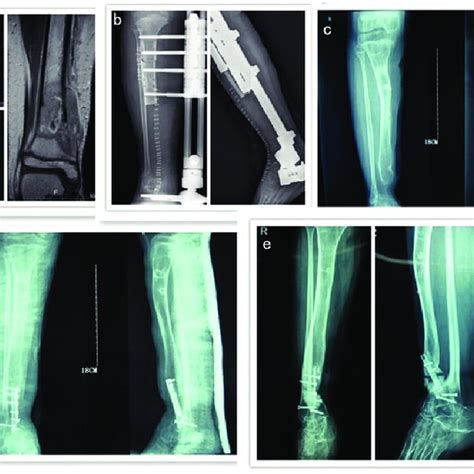 Pdf Bone Transport For Reconstruction Of Large Bone Defects After