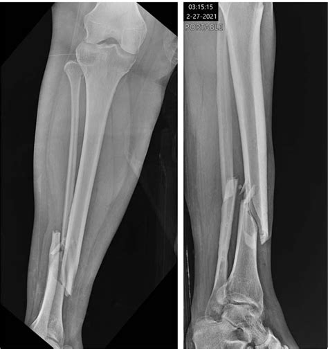 Initial Radiographs Demonstrating Fractures Of The Proximal Fibular
