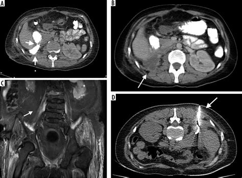 Percutaneous Catheter Drainage In Retroperitoneal Abscesses A Single