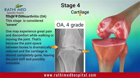 Kl Grade 4 Osteoarthritis Osteoarthritis Basics Overview Symptoms