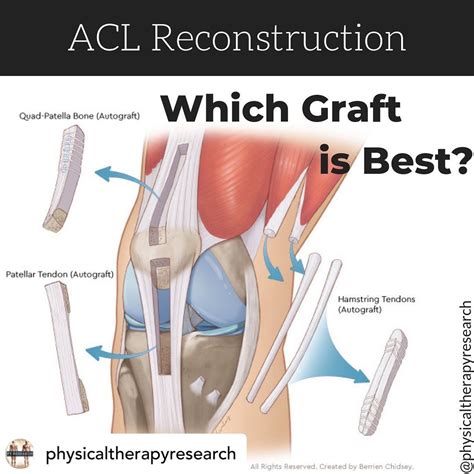 Acl Graft Rehabilitation Exercises Sports Medicine Injury Prevention Acl Graft Rehabilitation Exercises Sports Medicine Injury Prevention