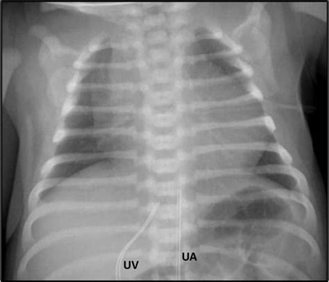 Pulmonary Atresia With Intact Septum
