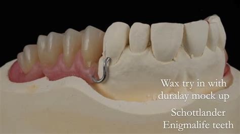 Finlays Newsletter 60 Sylvias Upper Kennedy Class 2 Mod 1 Metal Based Upper Rpd Finlay Finlays Newsletter 60 Sylvias Upper Kennedy Class 2 Mod 1 Metal Based Upper Rpd Finlay