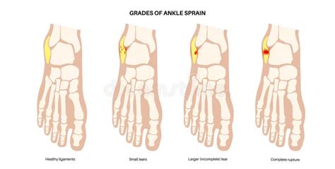 Sprained Ankle Injury Stock Vector Illustration Of Eversion 284411150