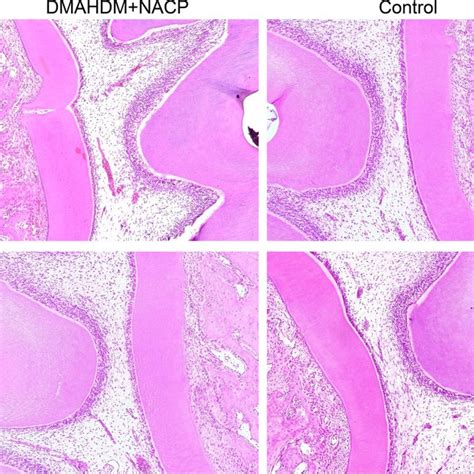 Evaluation Of Secondary Caries By Modified Keyes Caries Scoring Download Scientific Diagram