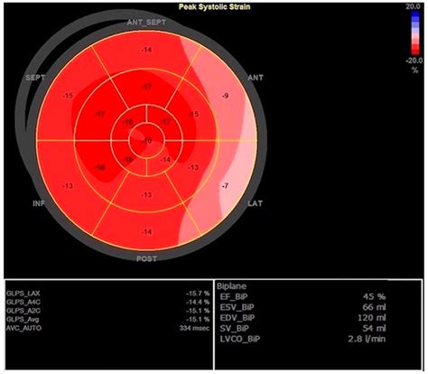 Perimyocarditis As First Manifestation Of Systemic Lupus Erythematosus