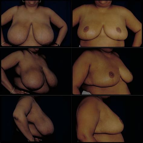 Most Unusual Looking Breast
