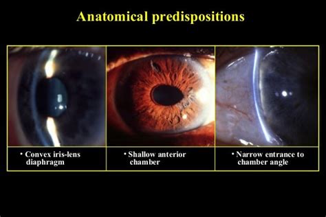 29 Primary Angle Closure Glaucoma
