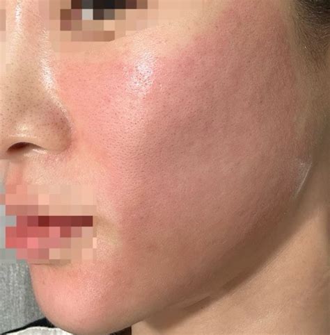 피코프락셀 효과 본 내돈내산 후기 여드름 모공축소 네이버 블로그