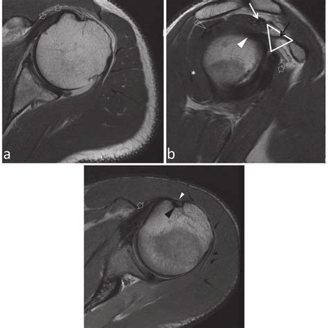 Goutallier Classification 20 Download Table