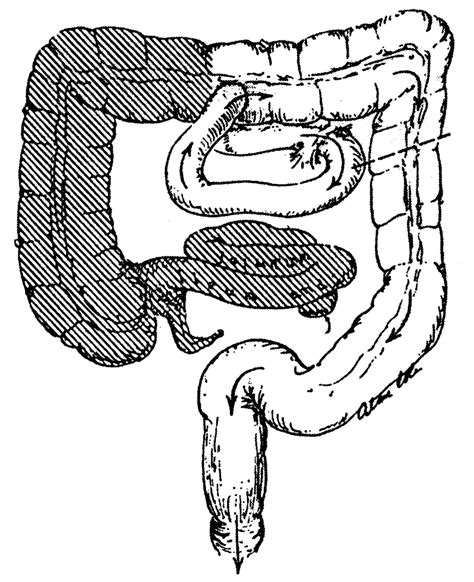 —the Initial Intestinal Bypass Operation Jejuno Colic Anastomosis Download Scientific Diagram