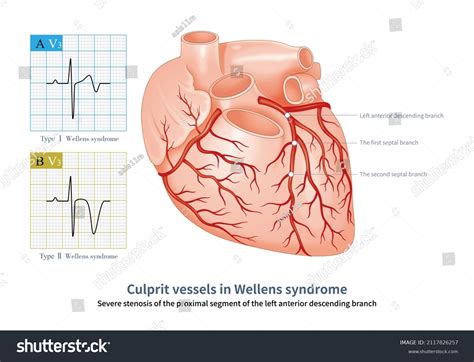 44 張 Proximal Lad Stenosis 圖片、庫存照片和向量圖 Shutterstock