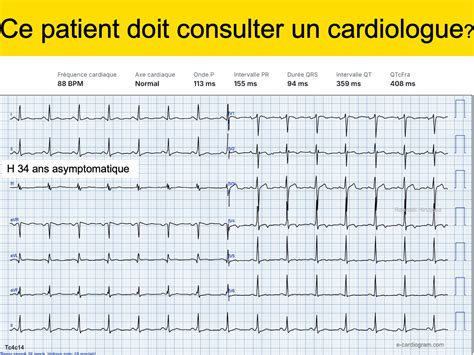 Arythmie Sinusale Respiratoire E Cardiogram