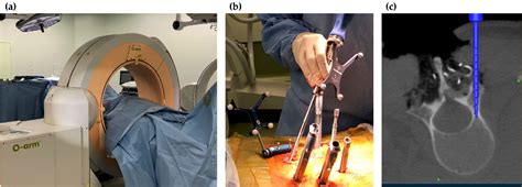 Figure 1 From Computed Tomography Based Navigation System In Current Spine Surgery A Narrative