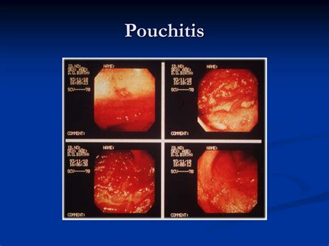 Ppt The Management Of Pouchitis And Cuffitis Powerpoint Presentation