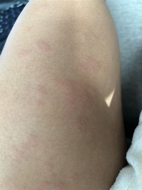 Hivesitchy Rlymphoma