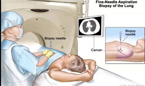 Ultrasoundct Guided Biopsyfnacaspirations Vascular Interventions
