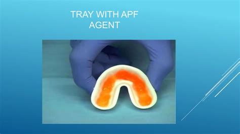 Apf Acidulated Phosphate Fluoride Ppt