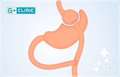 Mini Gastric Bypass In Turkey G Clinic