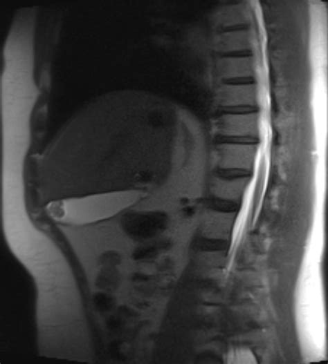 Radiopaedia Case Gallbladder Polyp Id Study Nc Commons