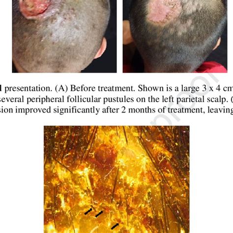 Dermoscopic Image Of Scalp Lesions Large Patches Of Erythema Scales Download Scientific