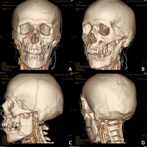 The Computerized Tomography Angiography And Three Dimensional