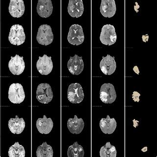 Some Examples Of Segmentation Results Of Our Proposed Brain Tumor Download Scientific Diagram
