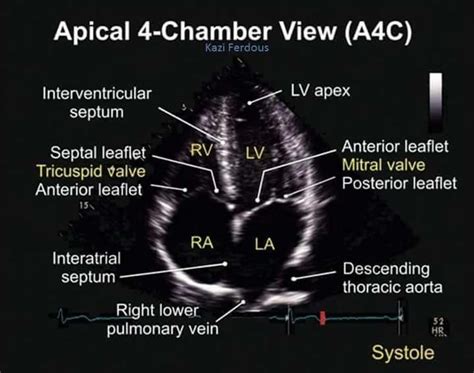 Apical 4 Chamber View Tee Diagnostic Medical Sonography Medical Ultrasound Diagnostic