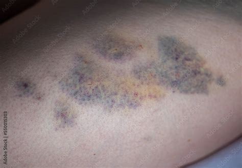 Bruises On The Skin Of The Patients Leg After Intramuscular Injections